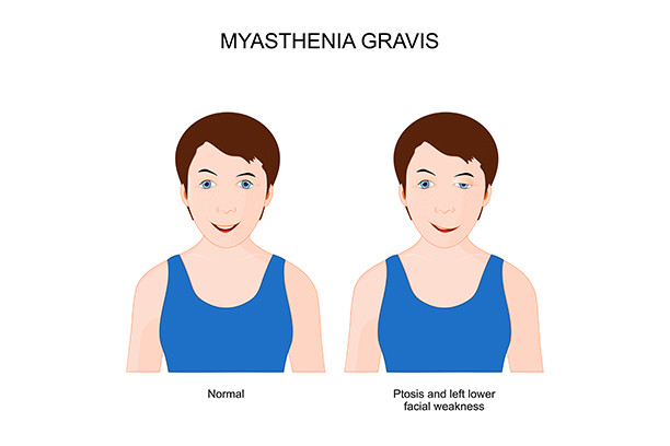 Myasthenia Gravis | FocusOn Neurology